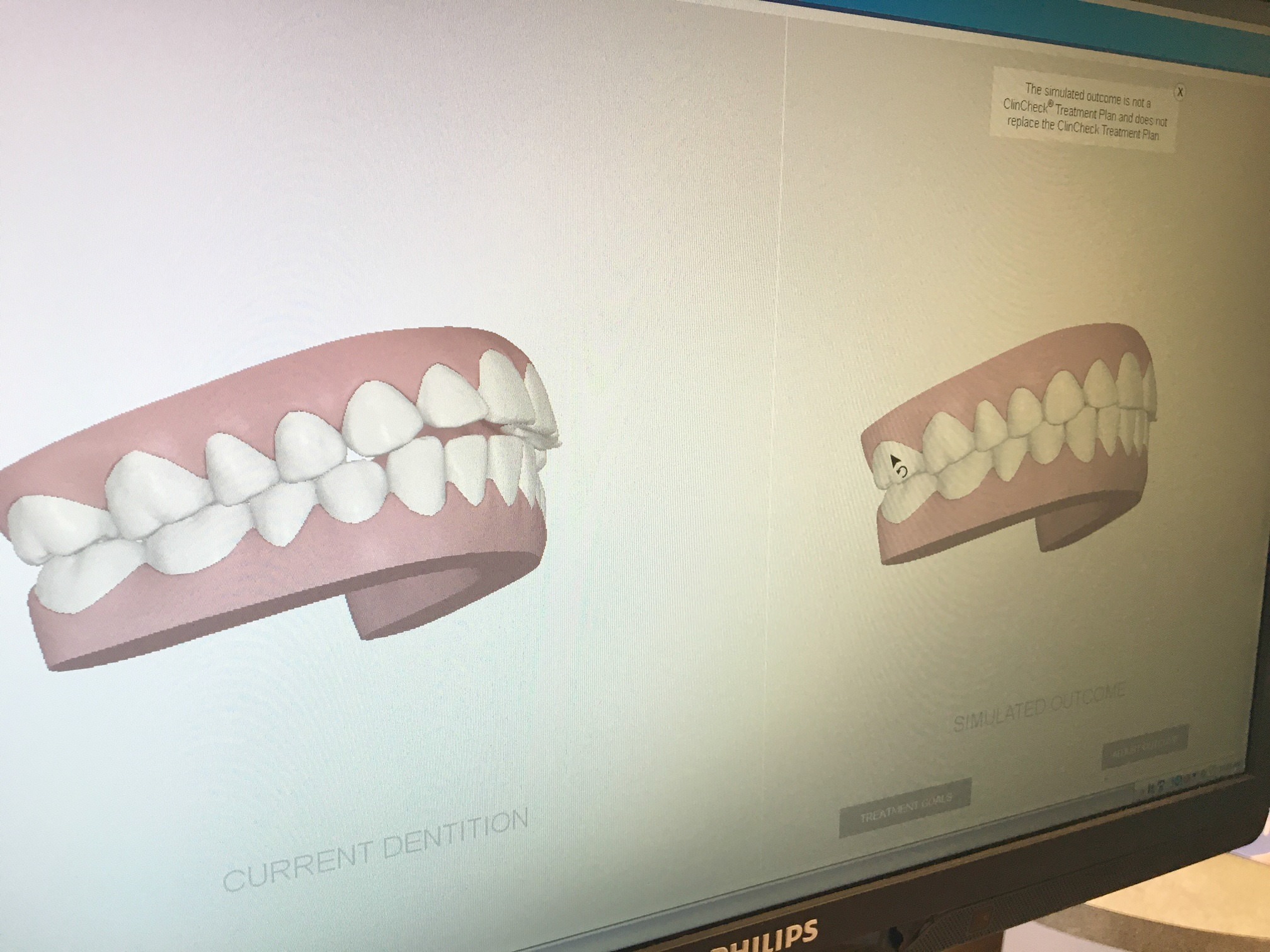 What to Expect with Invisalign: My First Six Weeks