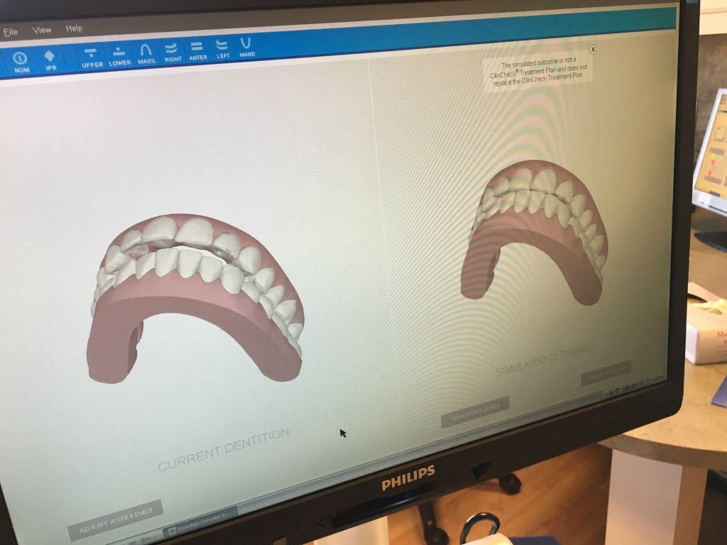 What to Expect with Invisalign: My First Six Weeks